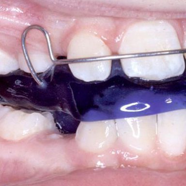 Blokbeugel - Kliniek de Meern